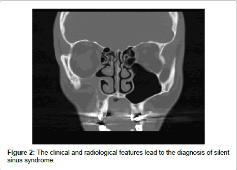 Silent Sinus Syndrome-A Rare Cause of Facial Asymmetry