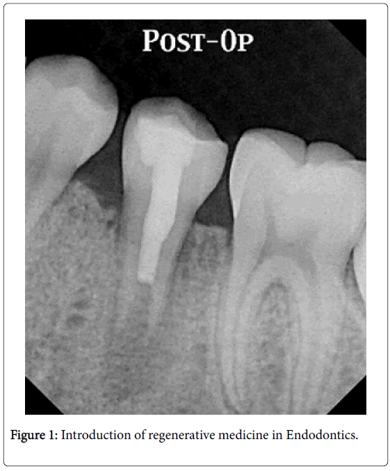 Regenerative Medicine in Endodontics: Time to Look Beyond the Root ...