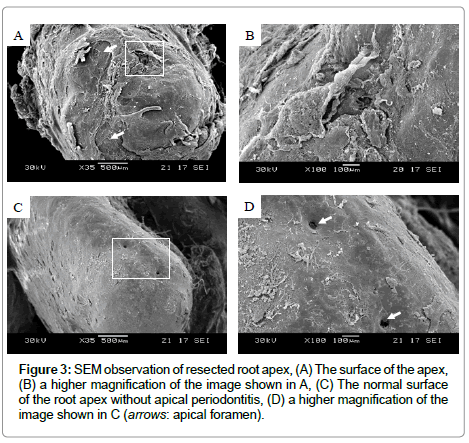 Management of Tooth and Observation of External Root Surface with