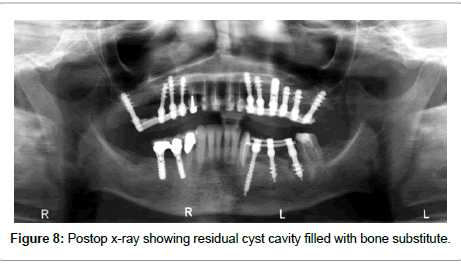 Case Report: Implant Placement and Immediate Loading With Simultaneous ...