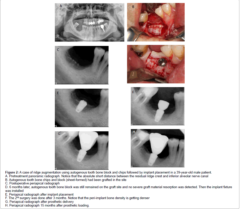 Delayed Implant Placement After Extraction Socket Reconstruction And ...