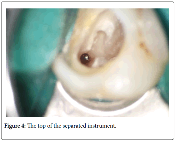 The Use Of Miller Broach During Microsonic Removal Of Separated ...