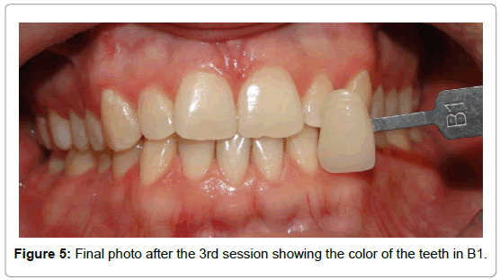 Dental Bleaching Using Violet Light Alone: Clinical Case Report