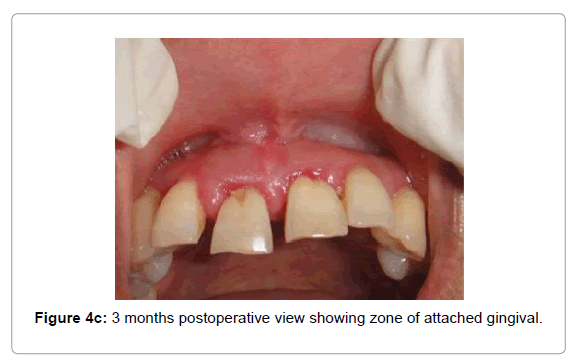 Comparative Results Of Frenectomy By Three Surgical Techniques ...