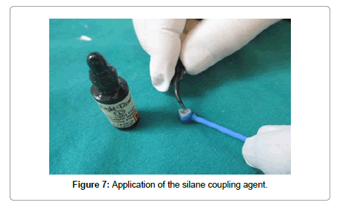 Bonding of all Ceramic Restorations