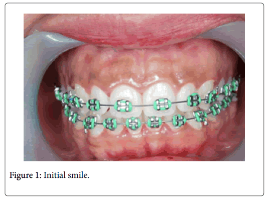 Esthetic Crown Lengthening with Flapless Osseous Reduction using
