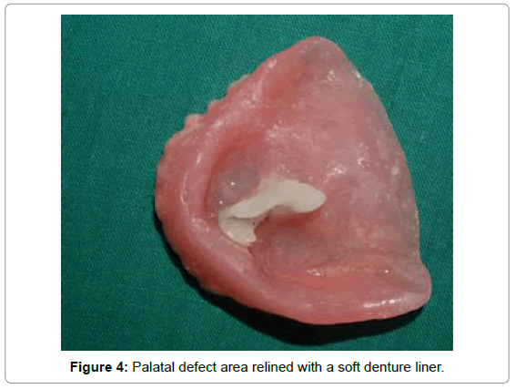 Prosthodontic Rehabilitation of a Completely Edentulous Cleft Palate ...