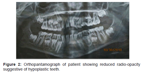 Extensive Hypoplasia of Permanent Dentition Due to Childhood Illn