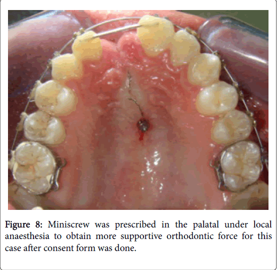 Orthodontic and Surgical Treatment in an Inverted Maxillary Impacted ...
