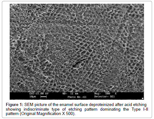 Enamel Deproteinization After Acid Etching - Is It Worth The Effo