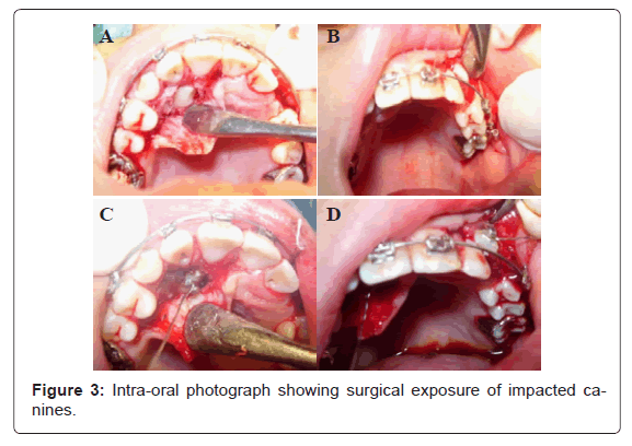 Bilateral Impacted Maxillary Canine with Left Lateral Incisor Root ...