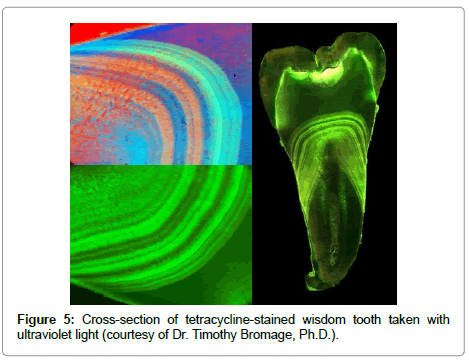 Unusual Root Staining of the Third Molars in a Patient Exposed to Lead ...