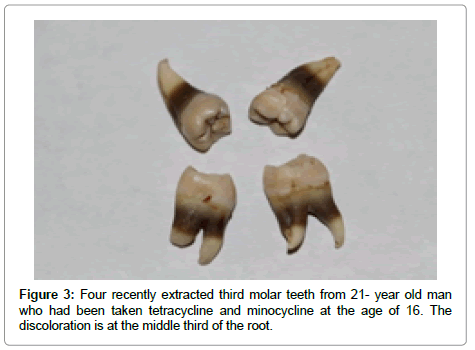 Unusual Root Staining of the Third Molars in a Patient Exposed to Lead ...