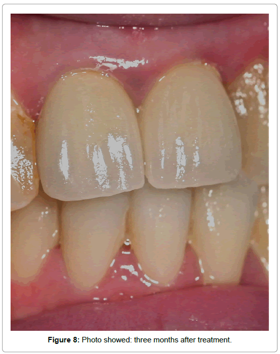 Multiple Applications with Er:YAG Laser in Apicoectomy - A Clinic