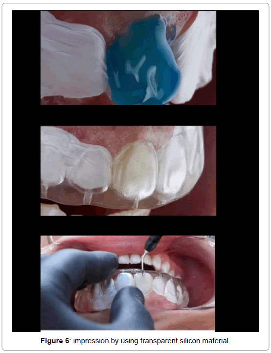 Bonded Functional Esthetic Prototypes (BFEPt): Review and a Case Report