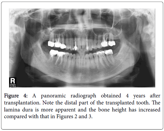 Autotransplantation for the Management of Teeth with Severe Alveo