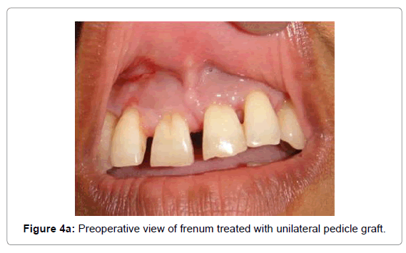 Comparative Results Of Frenectomy By Three Surgical Techniques ...