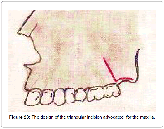 The Different Types of Flaps in the Surgical Relations of the Third ...