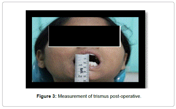 Efficacy of Methylprednisolone Injected into Masseter Muscle Preo