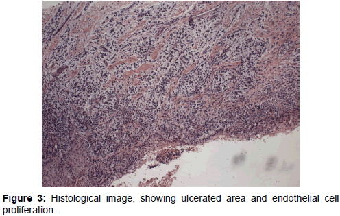 Oral Pyogenic Granuloma After Tongue Piercing Use: Case Report