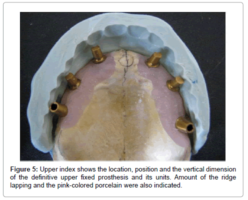 Mock-Up Driven Designing Of Full-Mouth Implant-Supported Metal-Ceramic ...