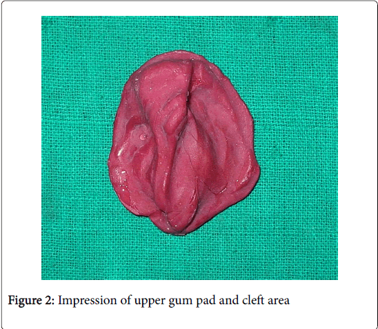 Meeting the Challenge of Feeding a New Born Infant with Cleft Lip and ...