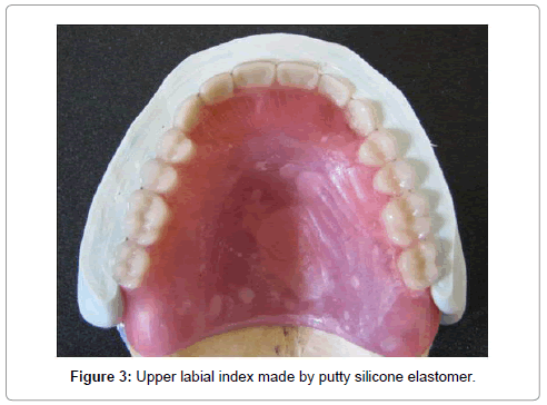 Mock-Up Driven Designing Of Full-Mouth Implant-Supported Metal-Ceramic ...