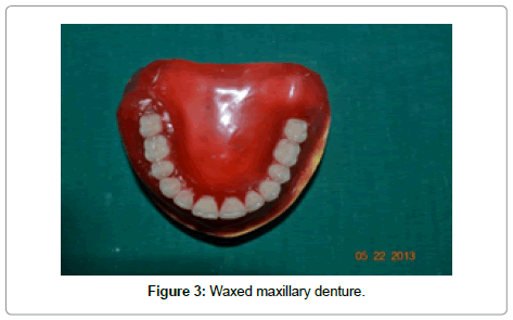 Cheek Plumper with a Salivary Reservoir: An Esthetic and Function