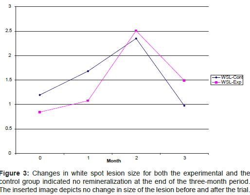 Clinically Assessing Remineralizing Therapies using Quantitative