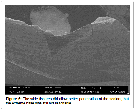 Morphology of Pits and Fissures Reviewed through Scanning Electro