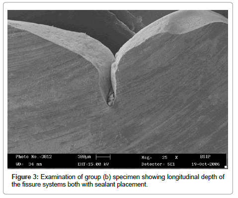 Morphology of Pits and Fissures Reviewed through Scanning Electro