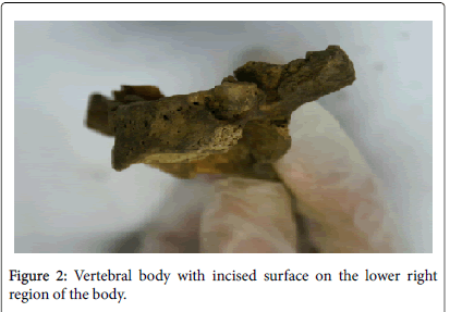 Study of Skeletal Remains: Solving a Homicide Case with Forensic ...