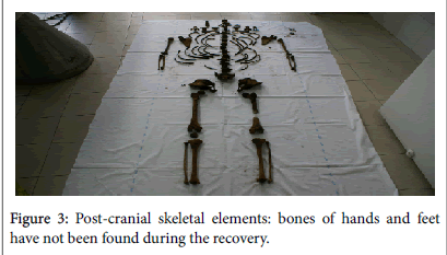 Study of Skeletal Remains: Solving a Homicide Case with Forensic ...