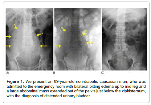 Urinary Bladder Distension Presenting with Lig Edema Duo to Venous ...