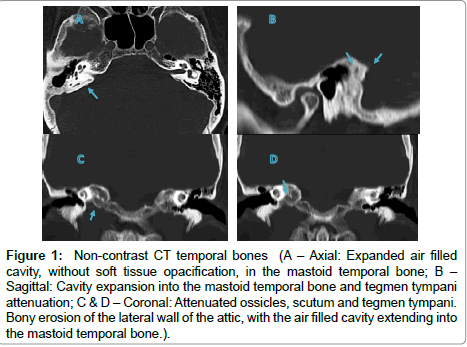 An Incidental Case of Auto-atticotomy