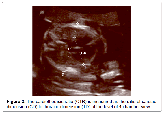 Lessons Learned from Two Missed Prenatal Cases of Hemoglobin Barts ...