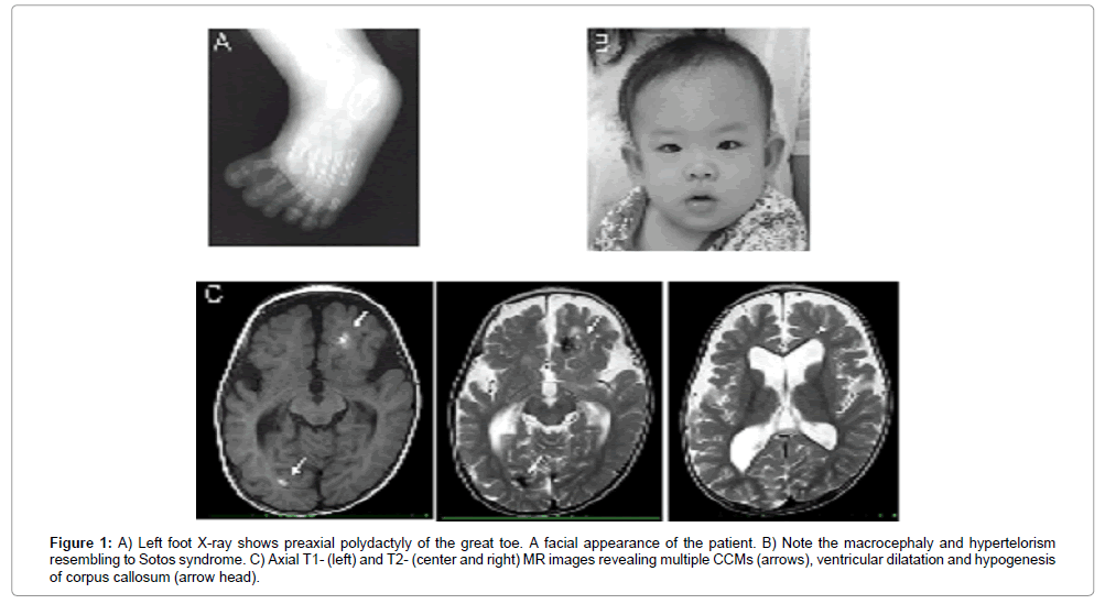 A Girl with Greig Cephalopolysyndactyly Contiguous Gene Deletion ...