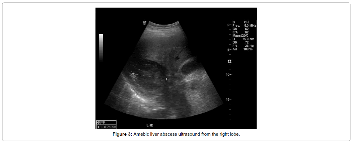 Amebic Liver Abscess: A New Perspective on the Prognosis of Patie