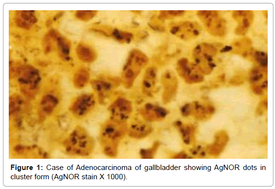 Prognostic significance of AgNOR Proliferative Index in gallbladd