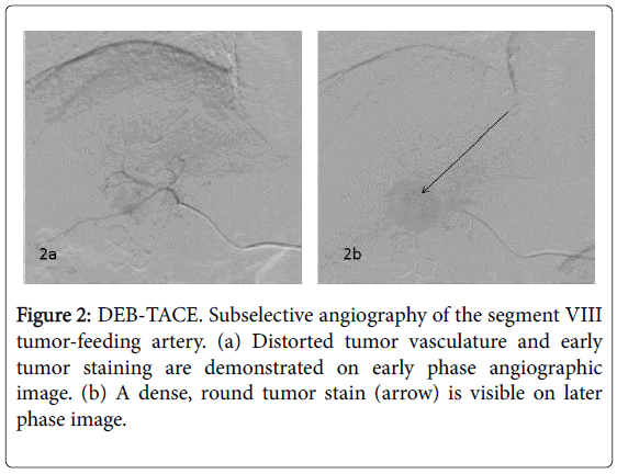 Watershed Hepatocellular Carcinoma – Utility of Cone Beam CT for ...