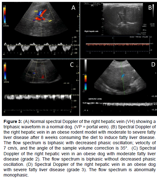 Association of Doppler Wave Pattern of Hepatic Veins and Fatty Liver ...