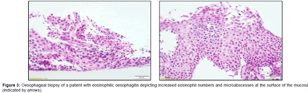 Eosinophilic GI Disorders (EGID) following Immunosuppression for Liver ...