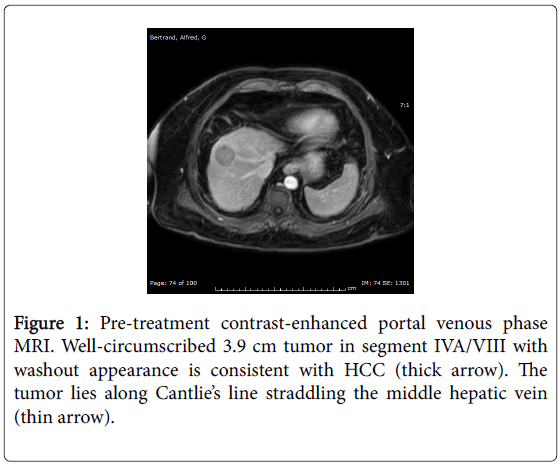Watershed Hepatocellular Carcinoma – Utility of Cone Beam C