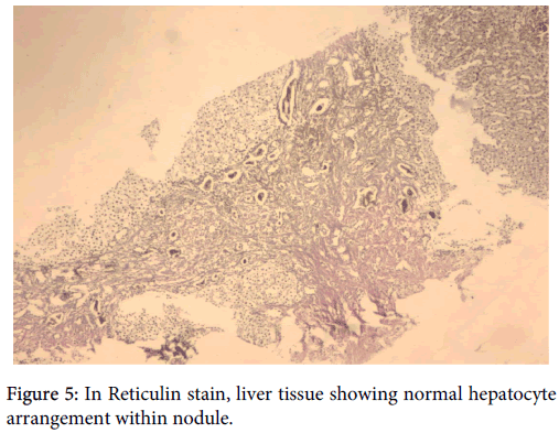 Congenital Hepatic Fibrosis Associated with Polycystic Kidney Disease