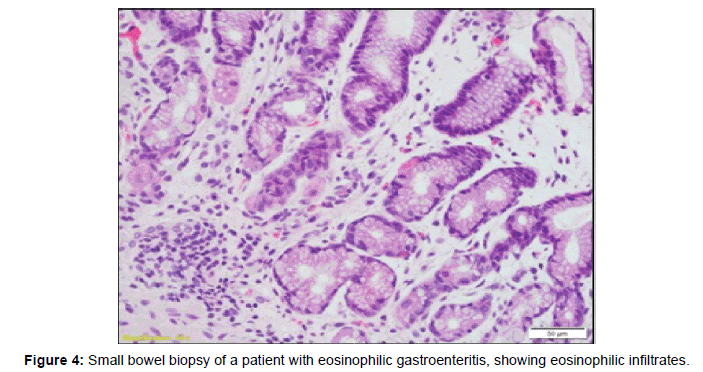 Eosinophilic GI Disorders (EGID) following Immunosuppression for Liver ...