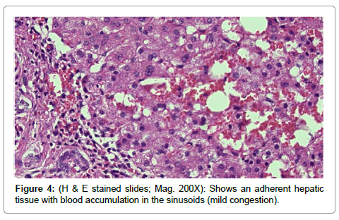 Gallbladder Stone Migrating in the Liver and Mimicking Gallbladder ...