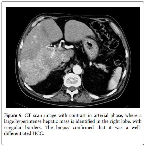 Radiological Patterns of Hepatocellular Cancers Vis-ï¿½?ï¿½?-Vis ...