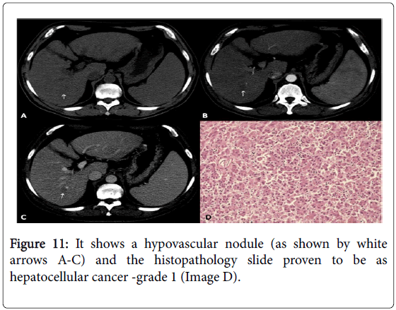 Radiological Patterns of Hepatocellular Cancers Vis-ï¿½?ï¿½?-Vis ...