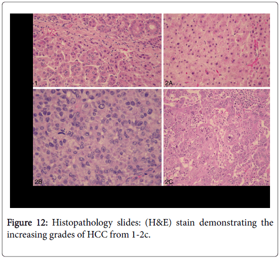 Radiological Patterns of Hepatocellular Cancers Vis-ï¿½?ï¿½?-Vis ...