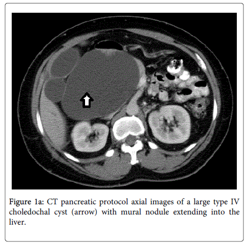 A Rare Cause of Biliary Obstruction